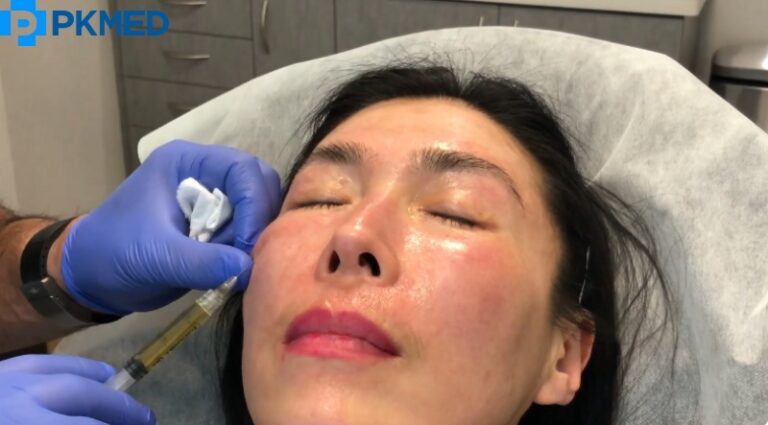 Tiêm meso botox là gì? Bí quyết xóa mờ nếp nhăn, trẻ hóa da